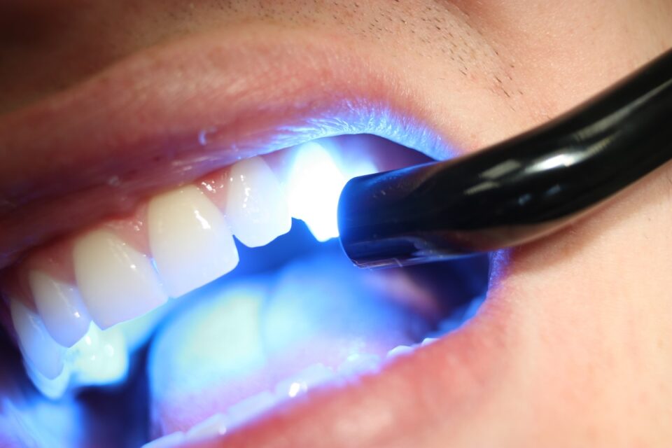 What to Do if Your Tooth Filling Fell Out? | Health By Helen