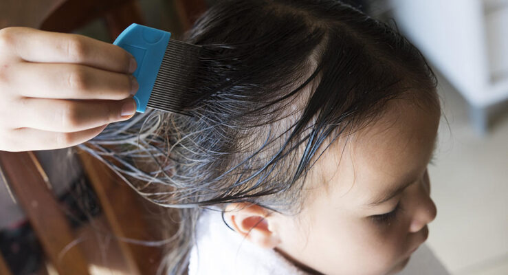 How To Prevent And Fight Head Lice In Children And Adults | Health By Helen